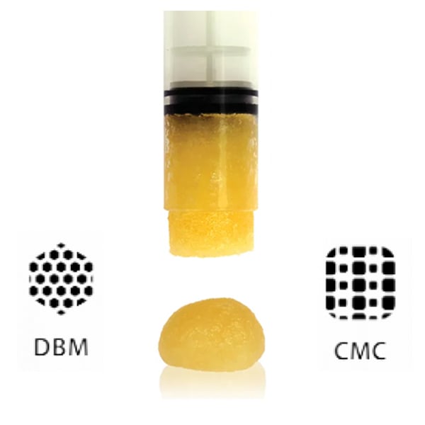 C-Graft Putty Demineralized Bone Matrix 1.0cc Syringe. Ready to use ...