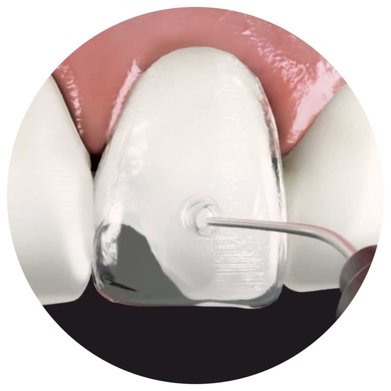 VeneerNow Injectable Matrix System Refills, Tooth 5, Medium/Large, 6/Pk ...