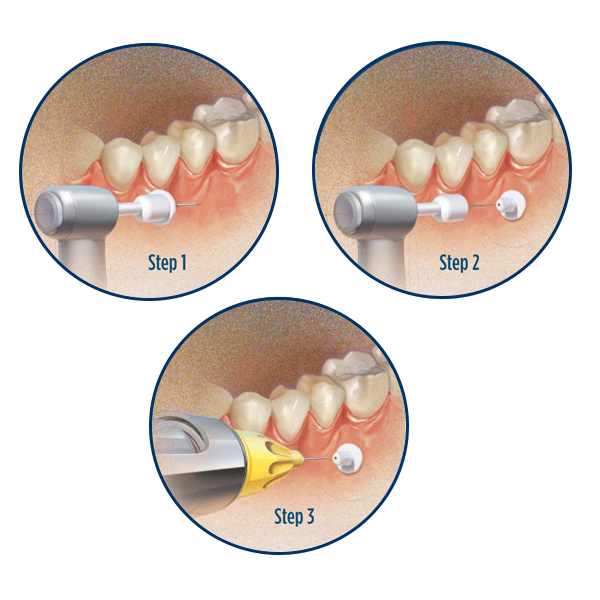 X-Tip 10-Pack Starter Kit. Intraosseous Anesthesia Delivery Tips | Net32