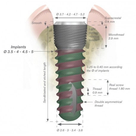 ETK Natural Anatomical Implant 4.0 x 12mm, Natural Implant was made of ...